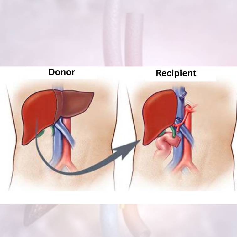 Living Donor Liver Transplantation in Bangalore - liver care