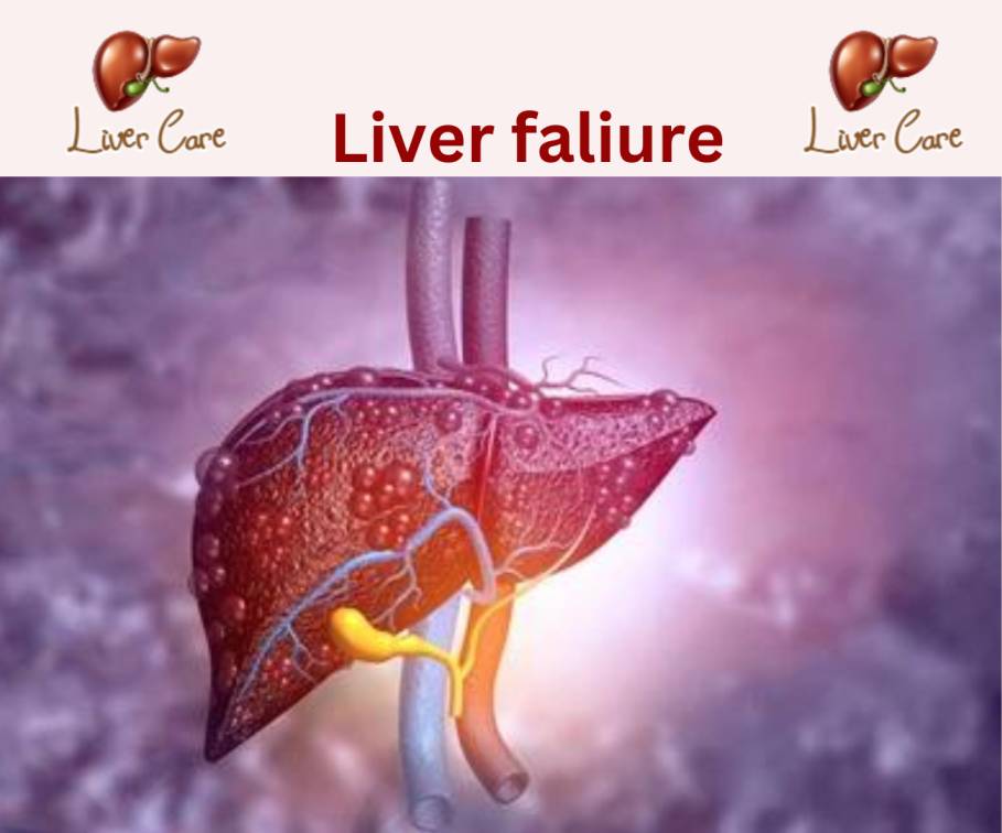 Acute chronic, Acute, liver failure treatment in Bangalore